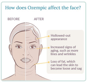 Is Ozempic too good to be true? - Women's Health Network